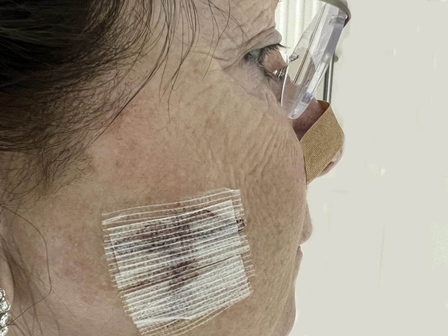 Everything You Need to Know About Mohs Surgery - A Guide